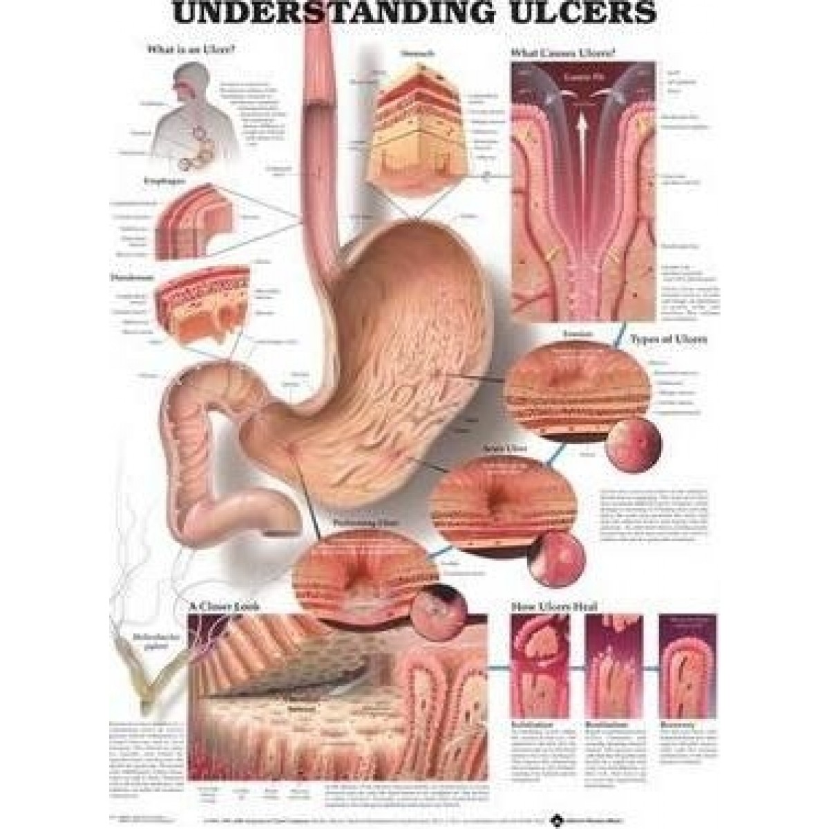 Anatomical Chart Company Understanding Ulcers Anatomical Chart School Locker